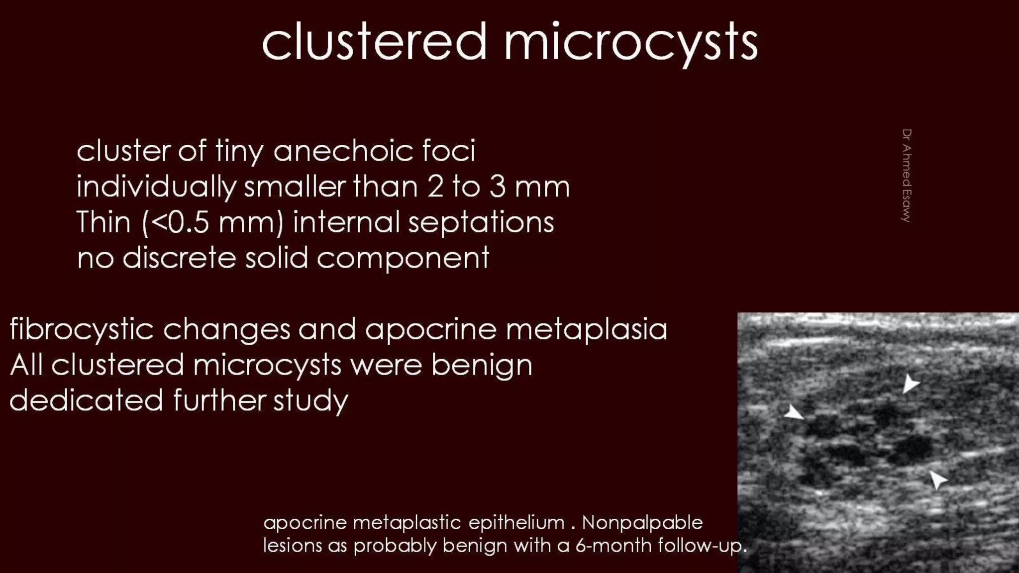 Breast cyst imaging | PPTX
