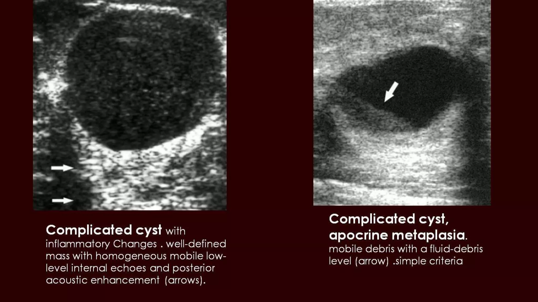Breast cyst imaging | PPTX