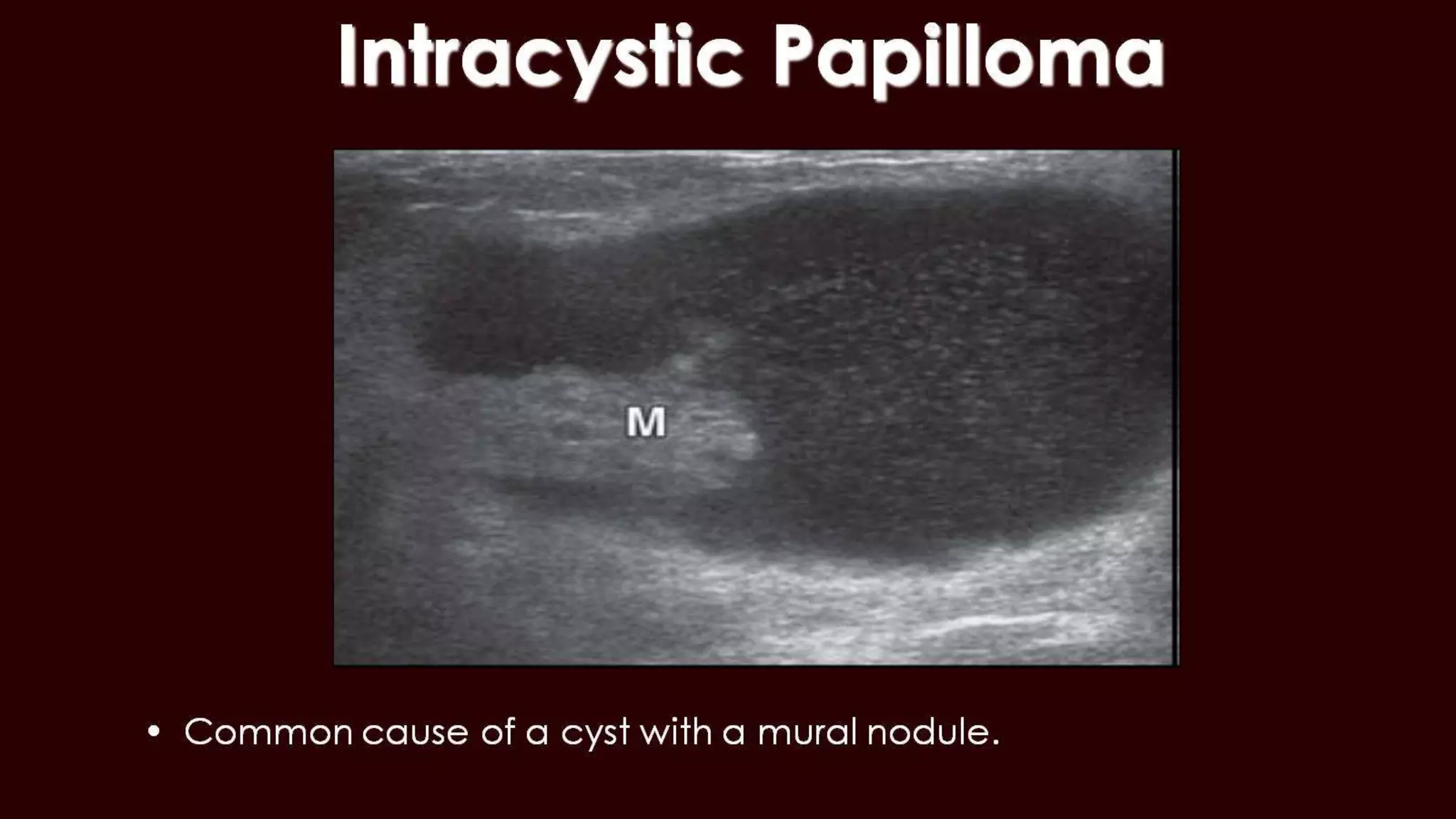 Breast cyst imaging | PPTX