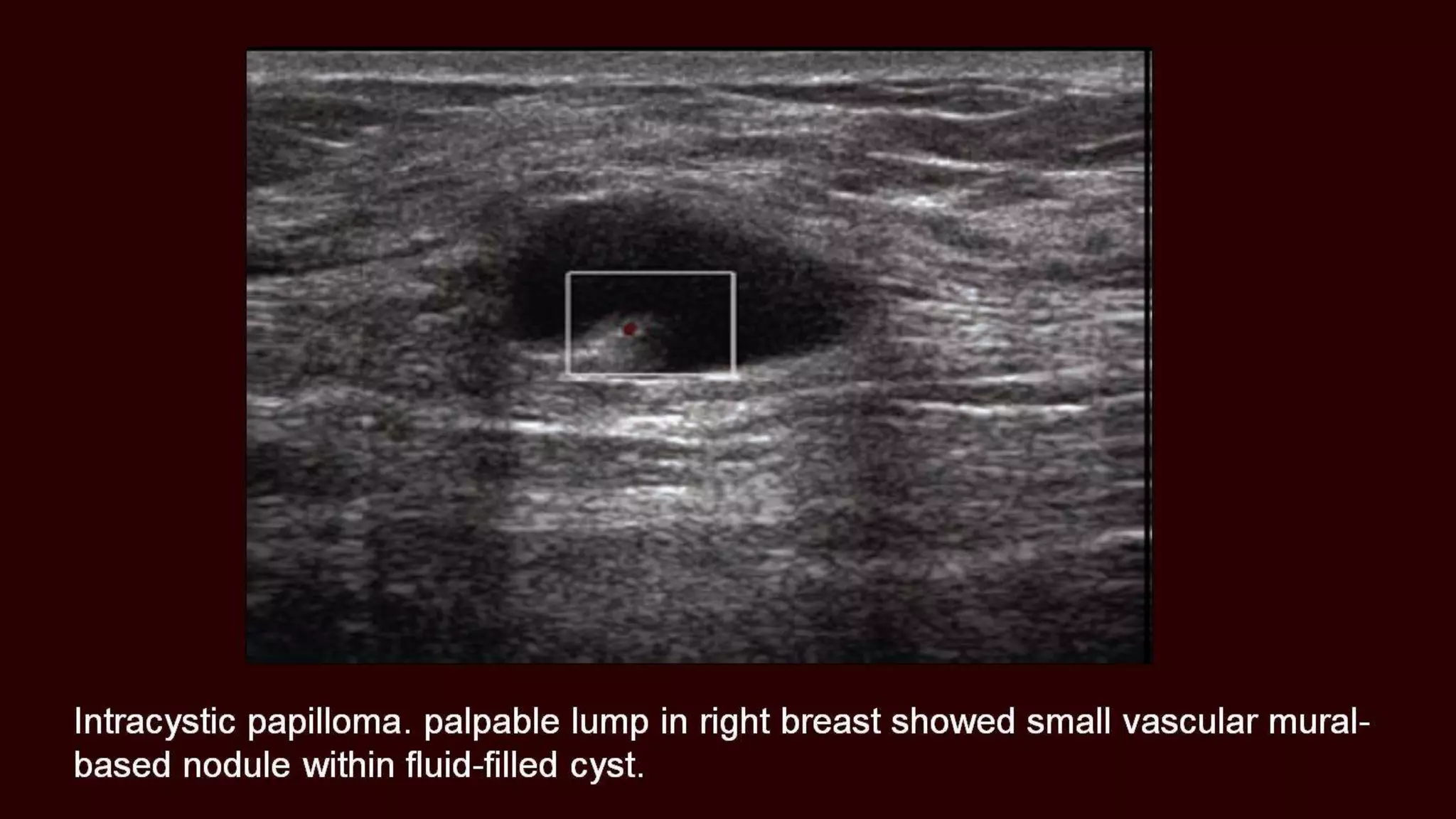 Breast cyst imaging | PPTX