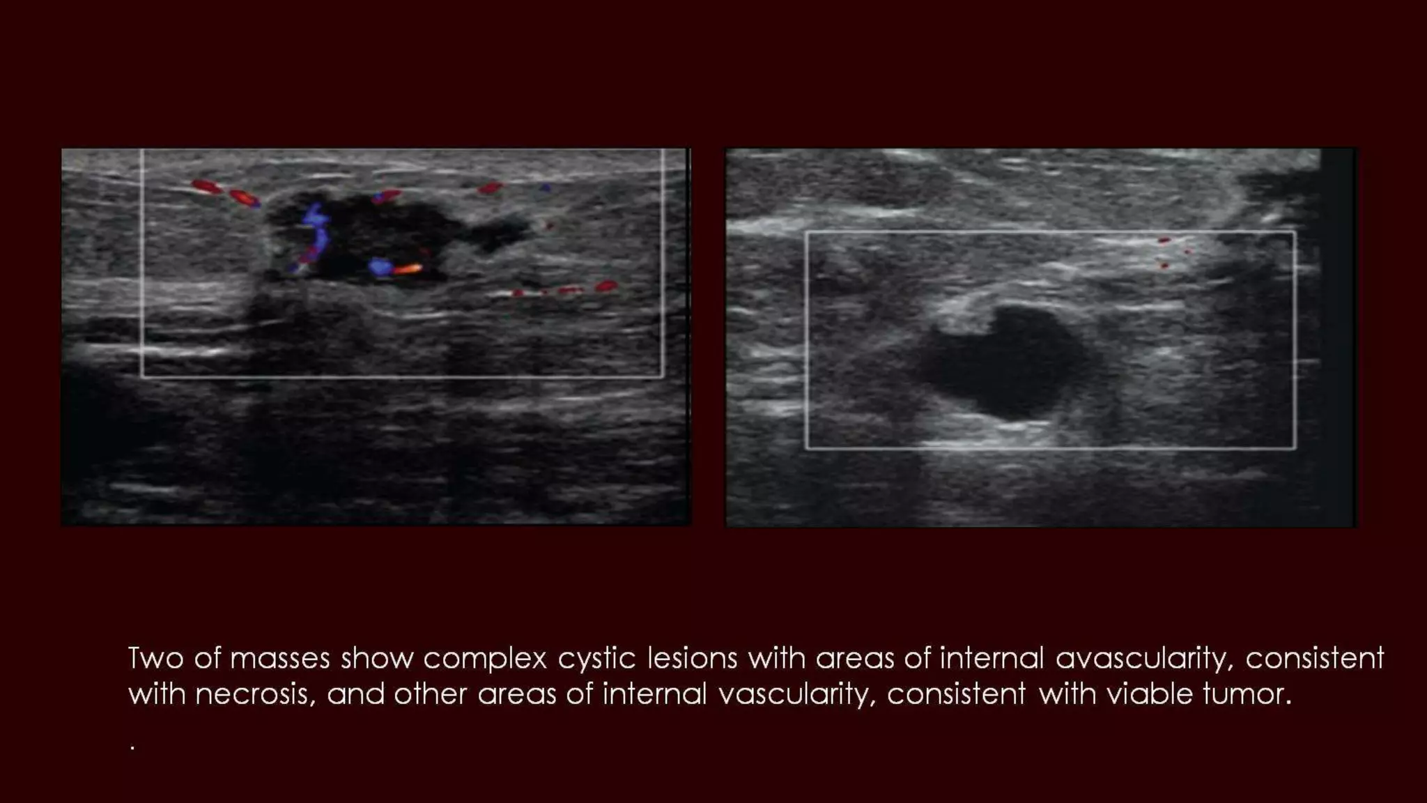 Breast cyst imaging | PPTX