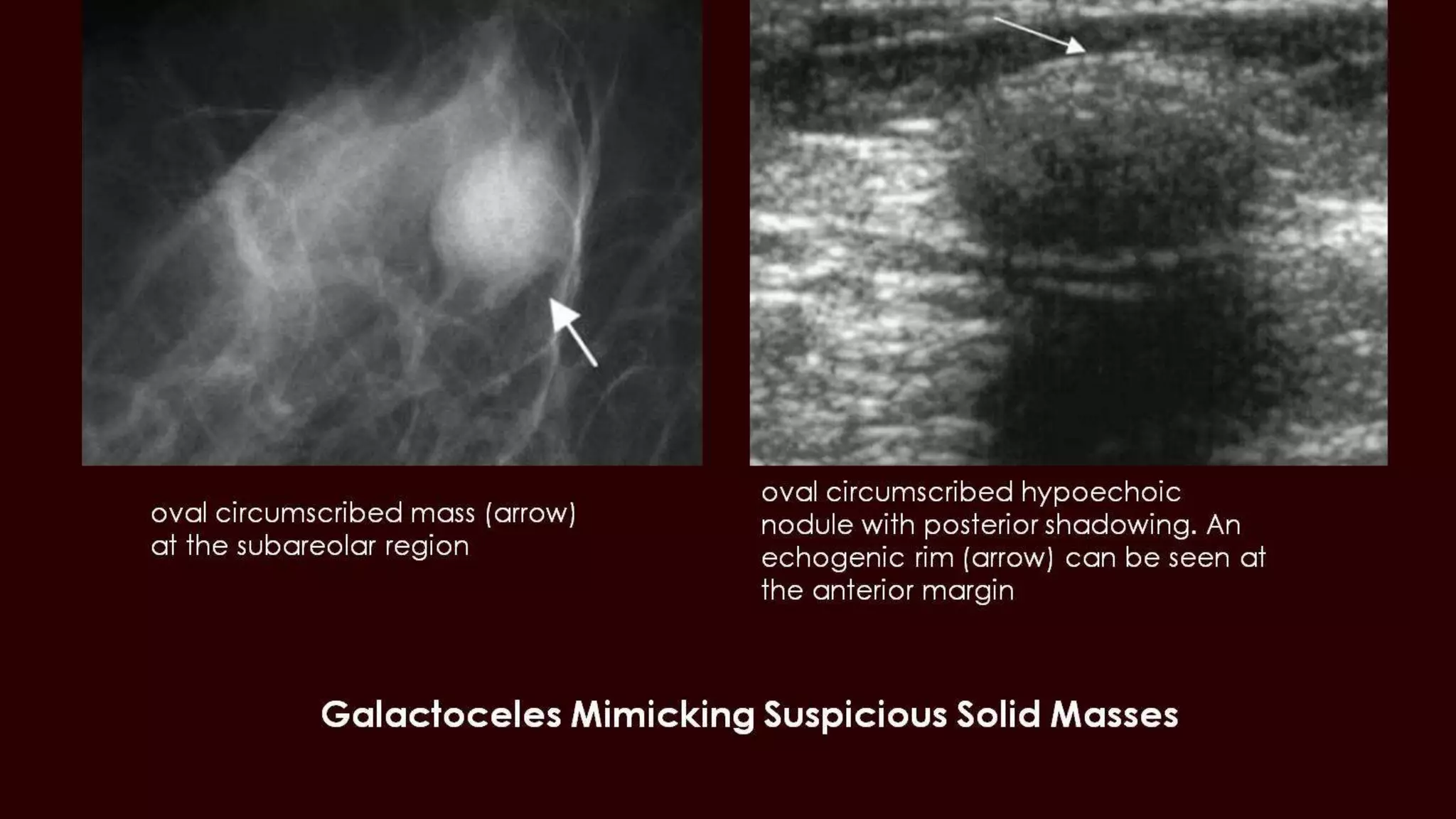 Breast cyst imaging | PPTX