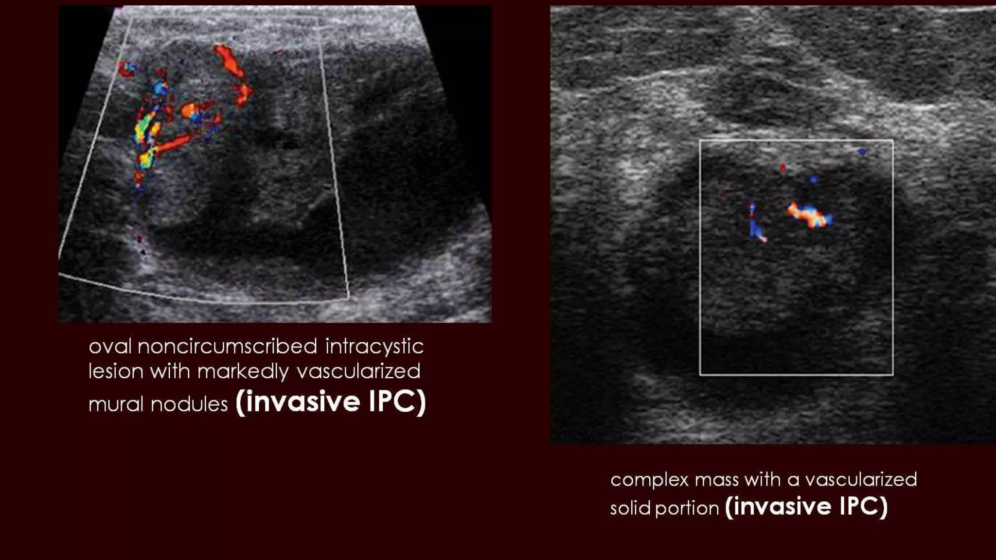Breast cyst imaging | PPTX