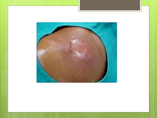 Breast disorder 3 | PPT