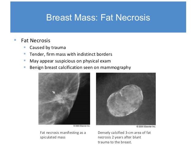 Breast disorders2 8-11