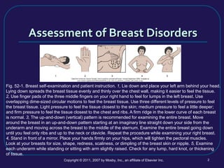 Breast disorders chapter 052 | PPT