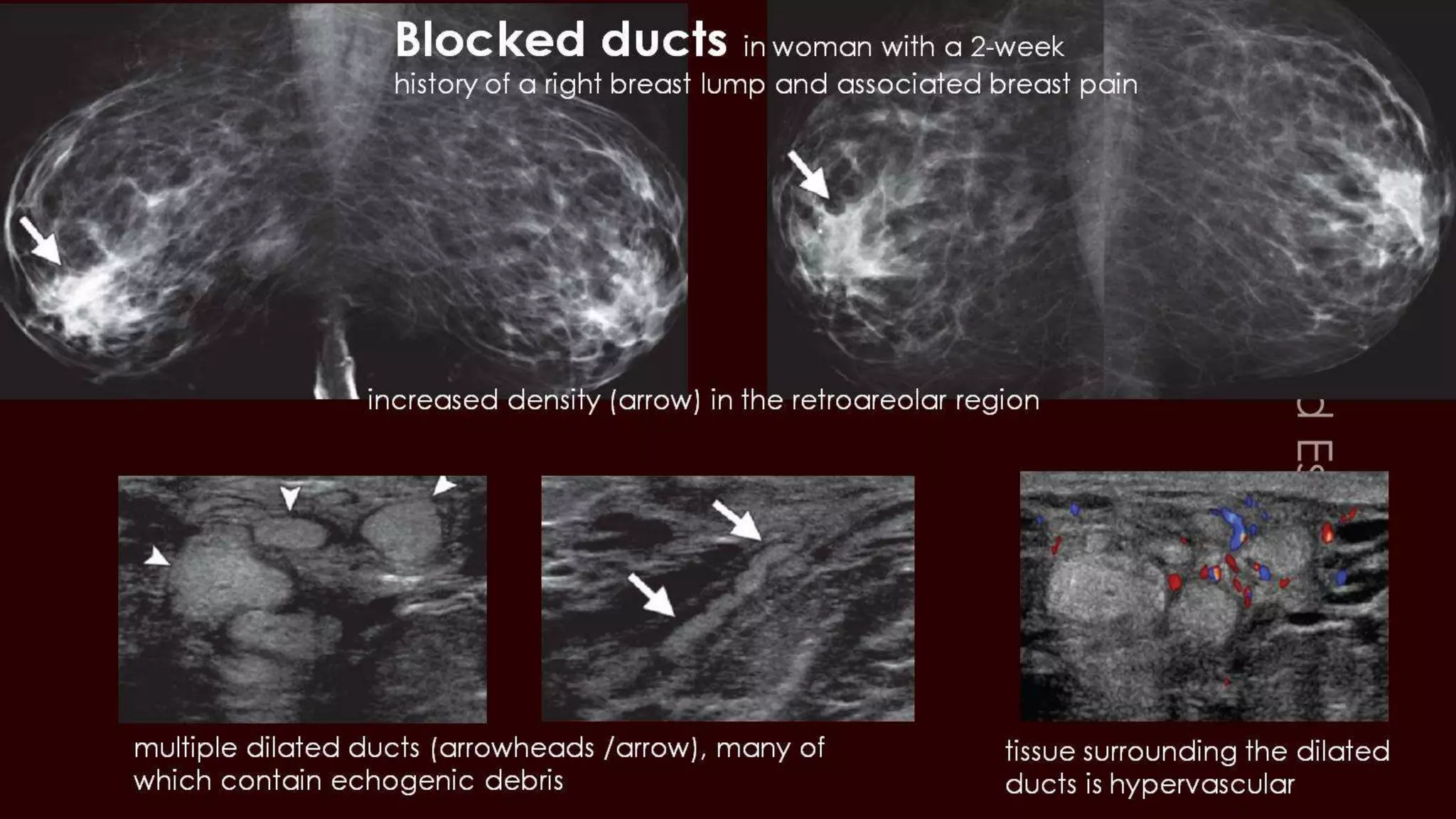 Breast duct ectasia us mammogram mri | PPTX