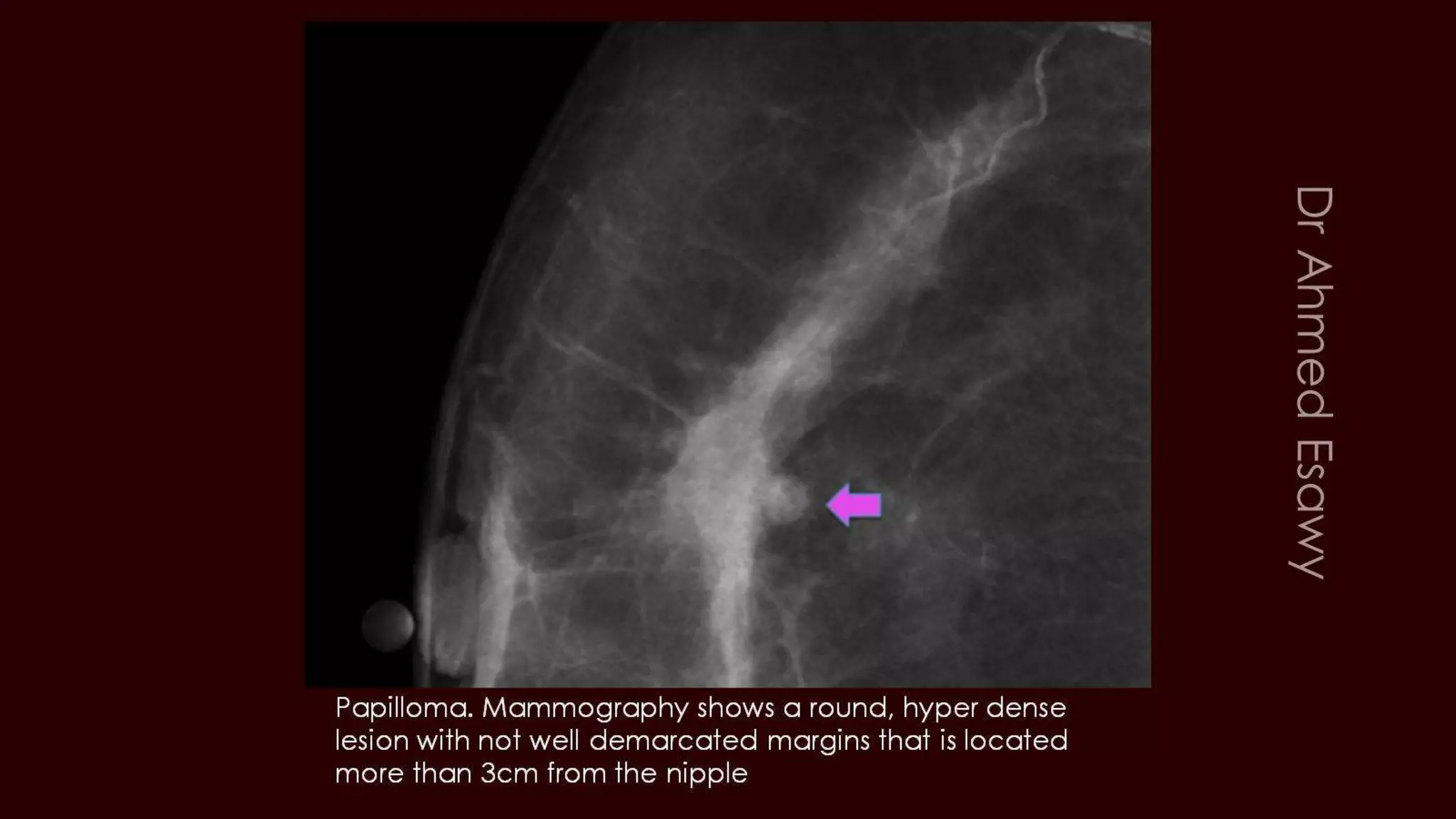 Breast duct ectasia us mammogram mri | PPTX