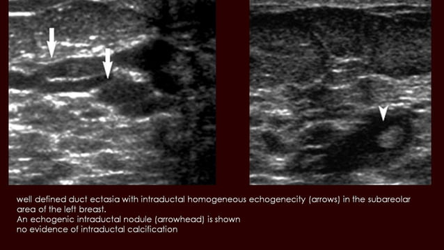 Breast duct ectasia us mammogram mri | PPTX