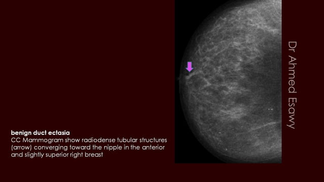 Breast duct ectasia us mammogram mri | PPTX