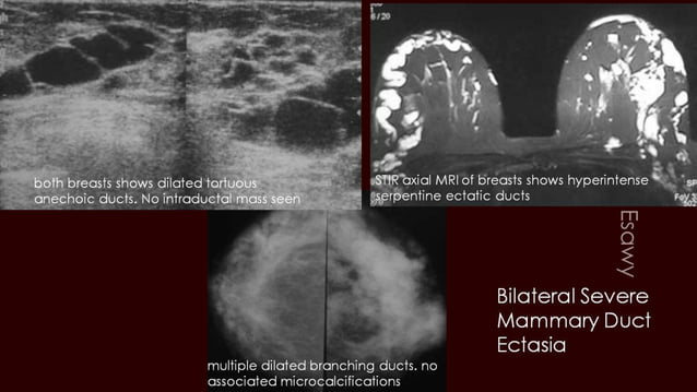 Breast duct ectasia us mammogram mri | PPTX