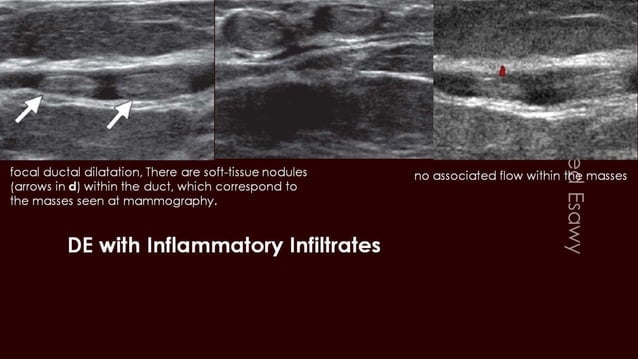 Breast duct ectasia us mammogram mri | PPTX