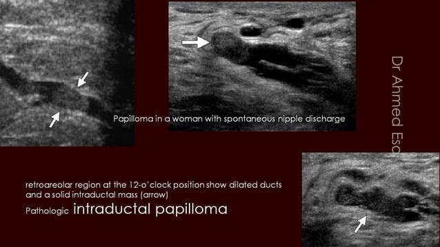 Breast duct ectasia us mammogram mri | PPTX