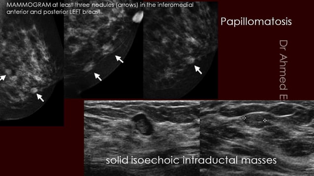 Breast duct ectasia us mammogram mri | PPTX