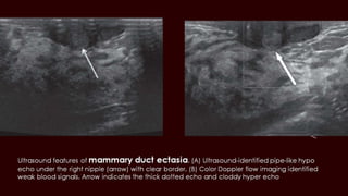 Breast duct ectasia us mammogram mri | PPTX