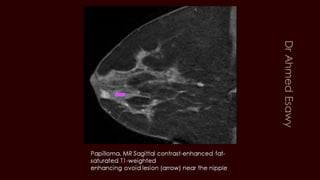 Breast duct ectasia us mammogram mri | PPTX