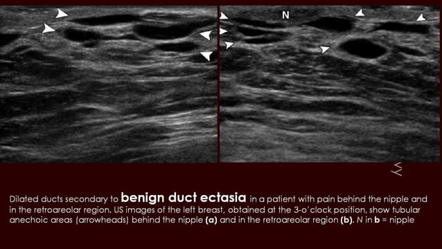 Breast duct ectasia us mammogram mri