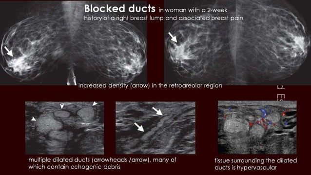 Breast duct ectasia us mammogram mri
