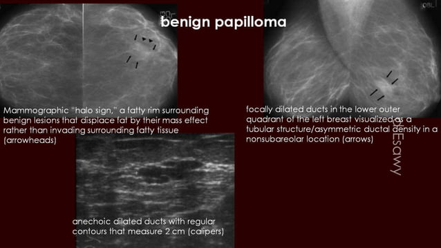 Breast Duct Ectasia Us Mammogram Mri