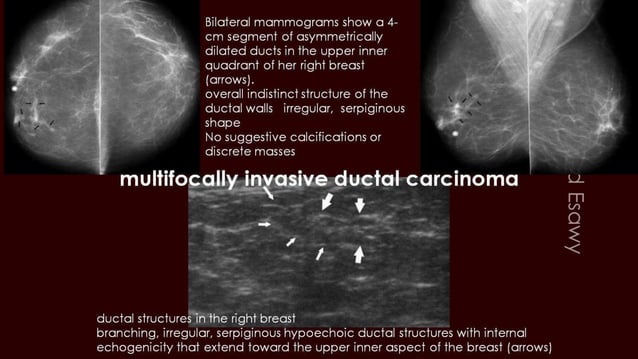 Breast duct ectasia us mammogram mri