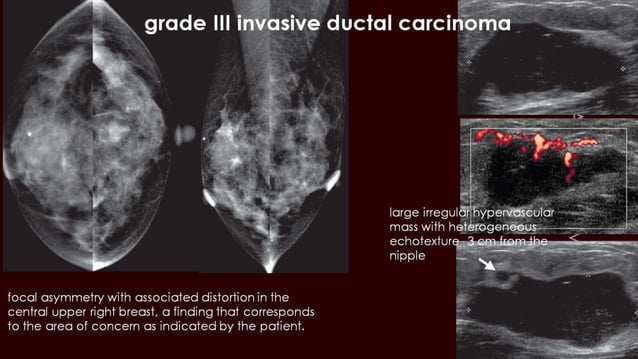 Breast duct ectasia us mammogram mri