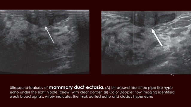 Breast duct ectasia us mammogram mri