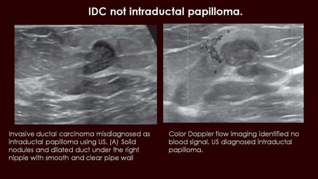 Breast duct ectasia us mammogram mri