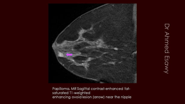 Breast duct ectasia us mammogram mri