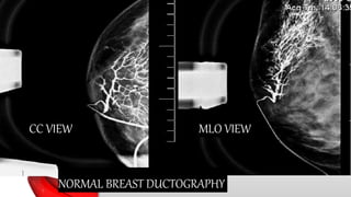 Breast Ductography.pptx