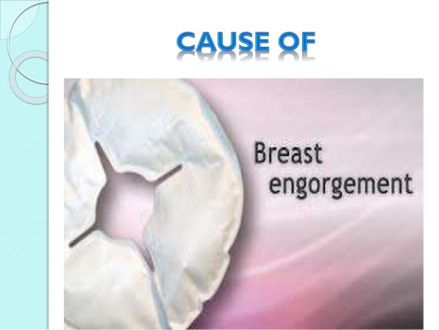 Breastengorgement 130621100349-phpapp02