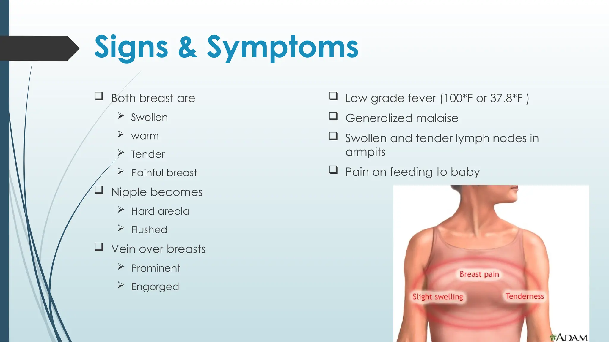 BREAST ENGORGEMENT.pptx definition types treatment prevention | PPTX