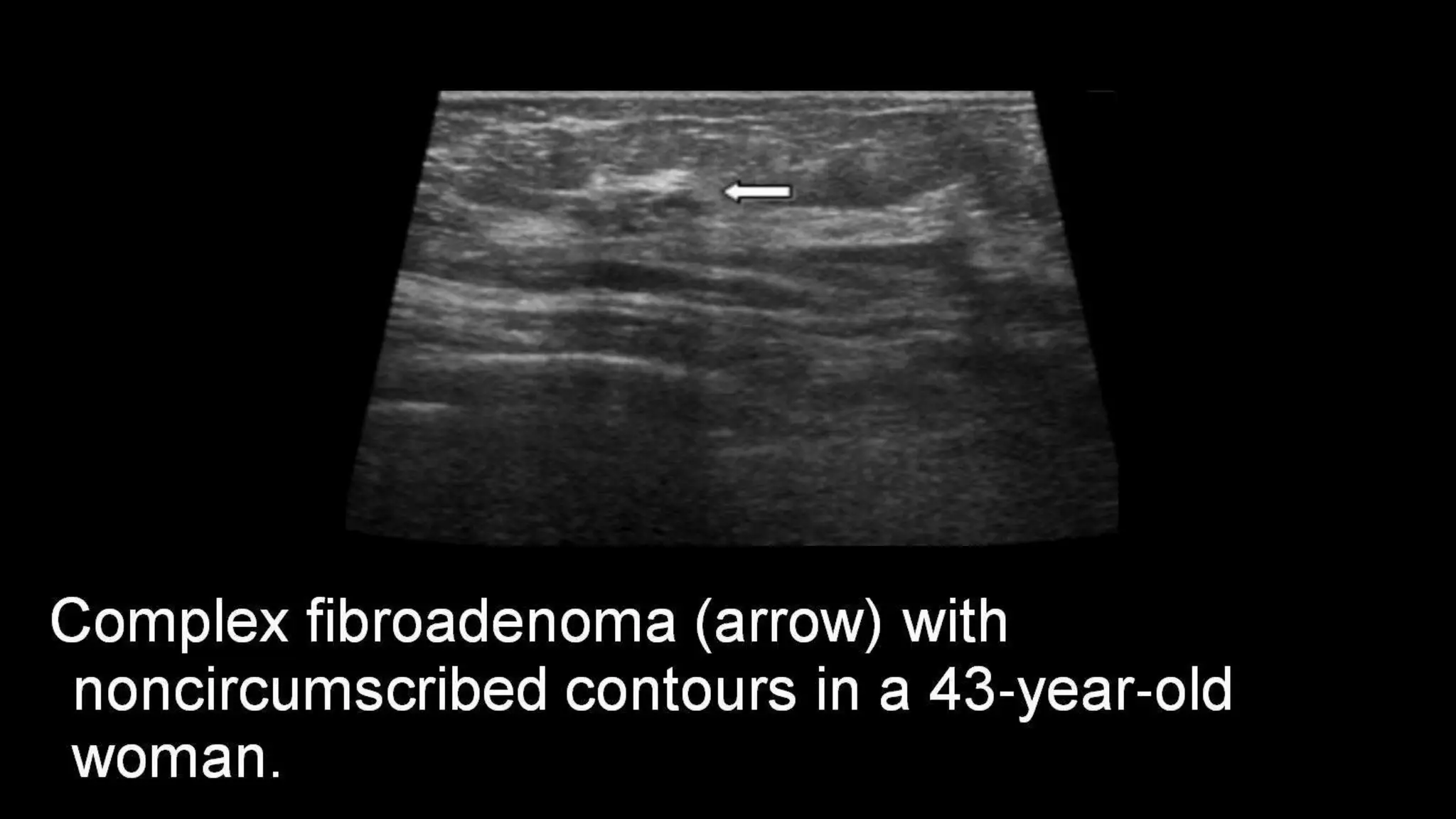 Breast fibroadenoma imaging | PPTX