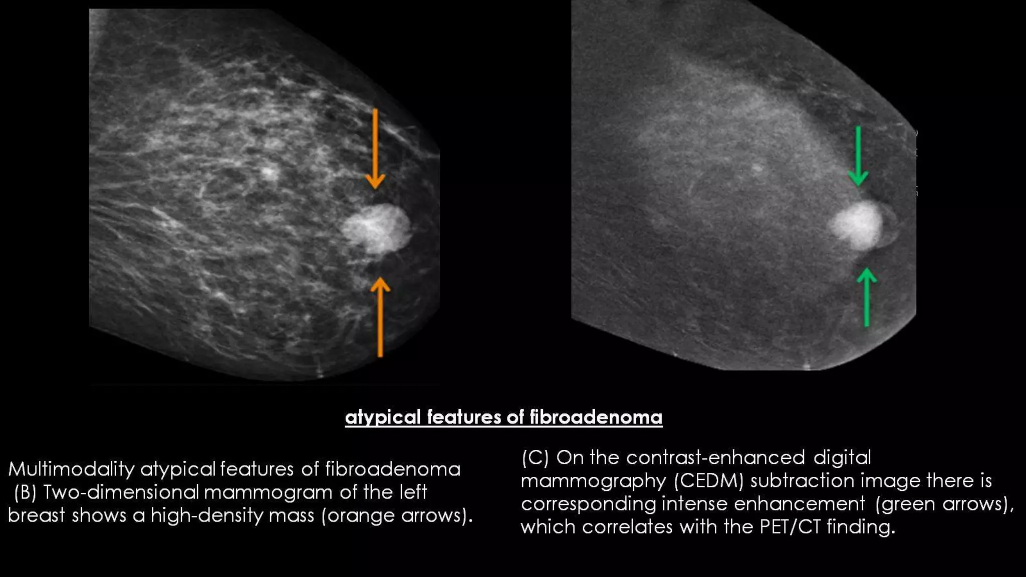 Breast fibroadenoma imaging | PPTX