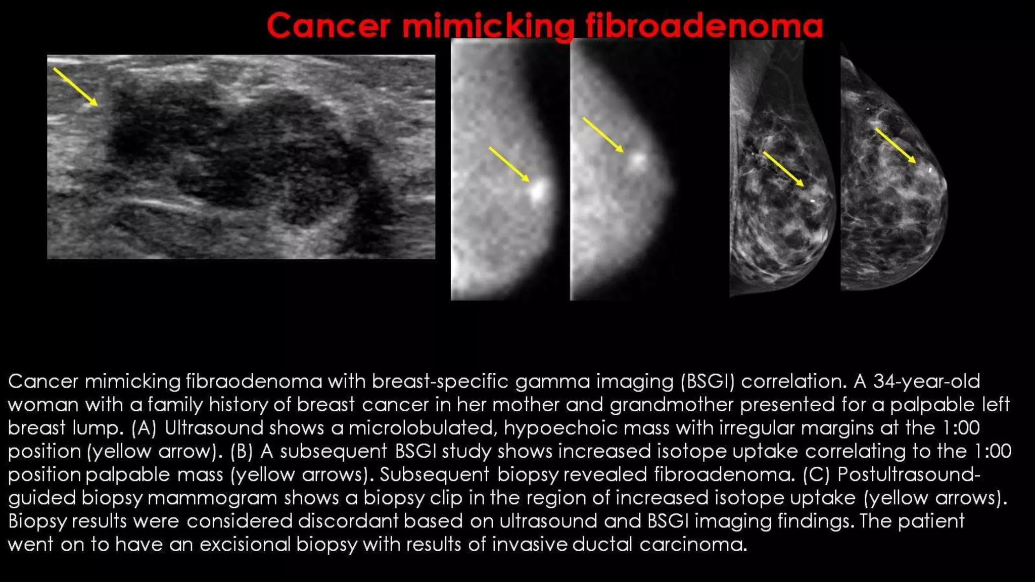 Breast fibroadenoma imaging | PPTX