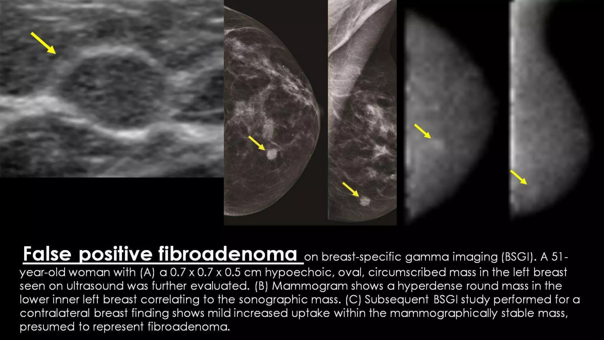 Breast fibroadenoma imaging | PPTX