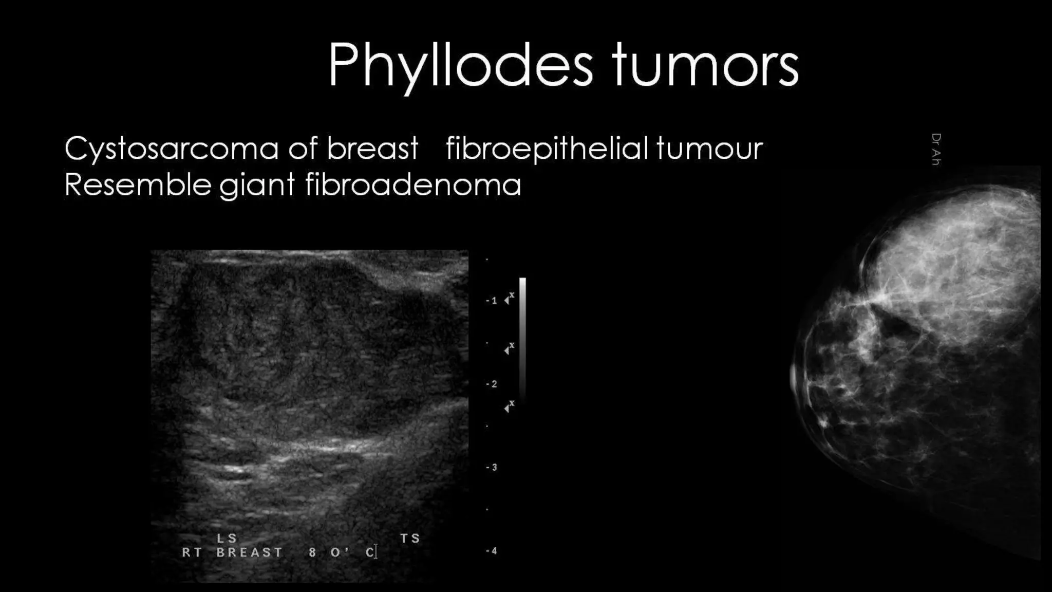Breast fibroadenoma imaging | PPTX