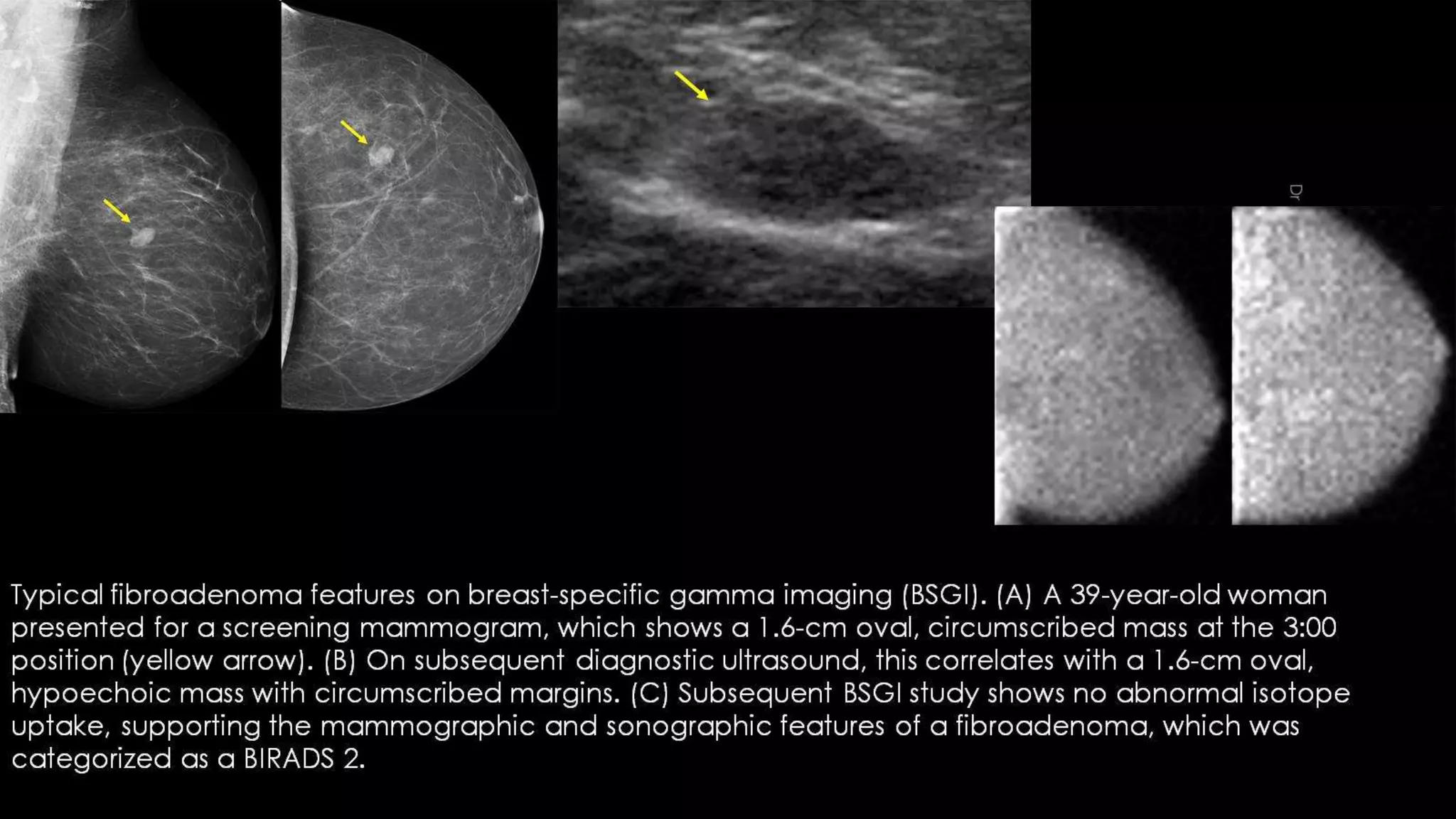 Breast fibroadenoma imaging | PPTX