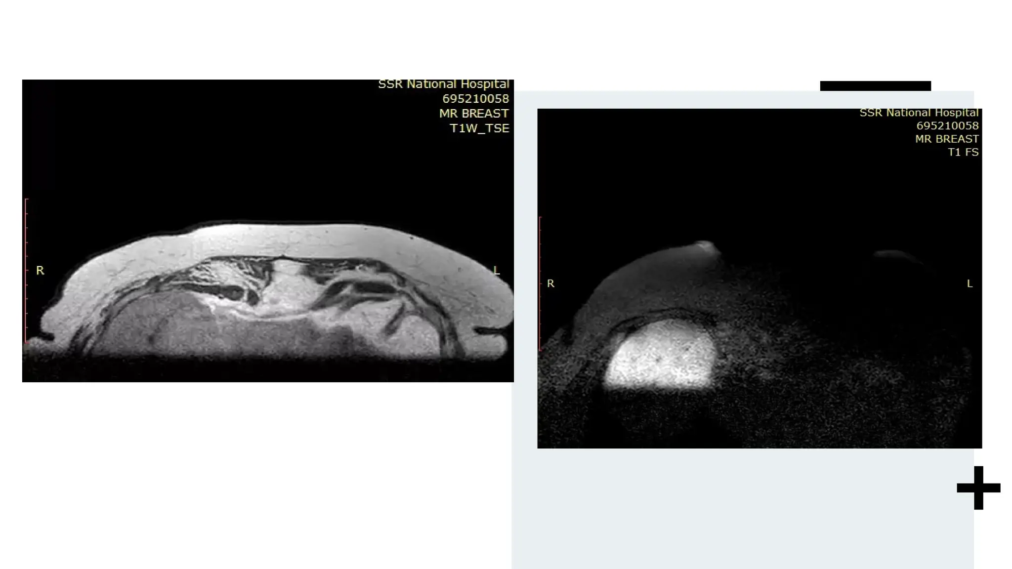Multimodality imaging of the breast- BI-RADS | PPTX