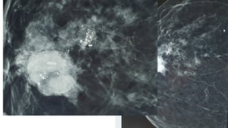 Multimodality imaging of the breast- BI-RADS | PPTX