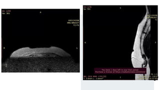 Multimodality imaging of the breast- BI-RADS | PPTX