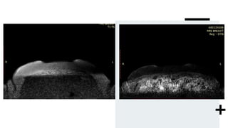 Multimodality imaging of the breast- BI-RADS | PPTX