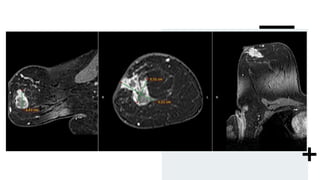 Multimodality imaging of the breast- BI-RADS | PPTX
