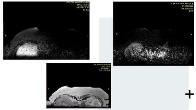 Multimodality imaging of the breast- BI-RADS | PPT
