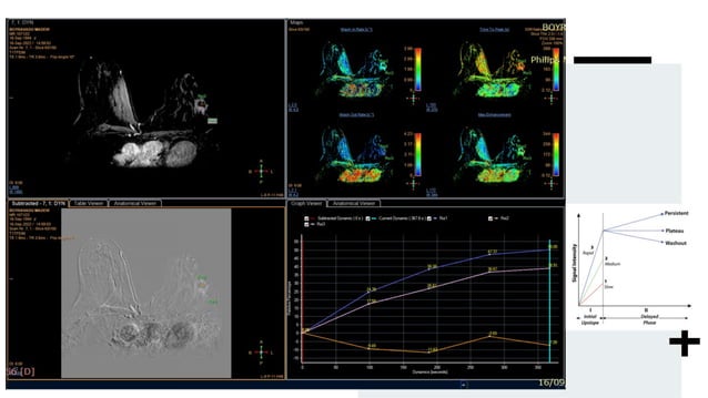 Multimodality imaging of the breast- BI-RADS | PPT