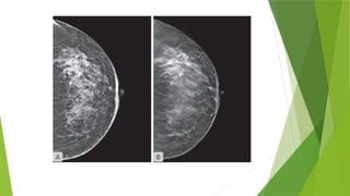 BREAST IMAGING OF ABNORMAL BREAST LESION AND USG GUIDED INTERVENTION | PPTX