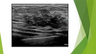 BREAST IMAGING OF ABNORMAL BREAST LESION AND USG GUIDED INTERVENTION | PPTX