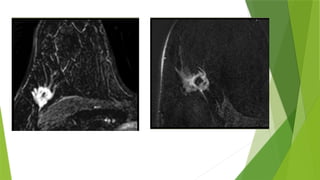 BREAST IMAGING OF ABNORMAL BREAST LESION AND USG GUIDED INTERVENTION | PPTX