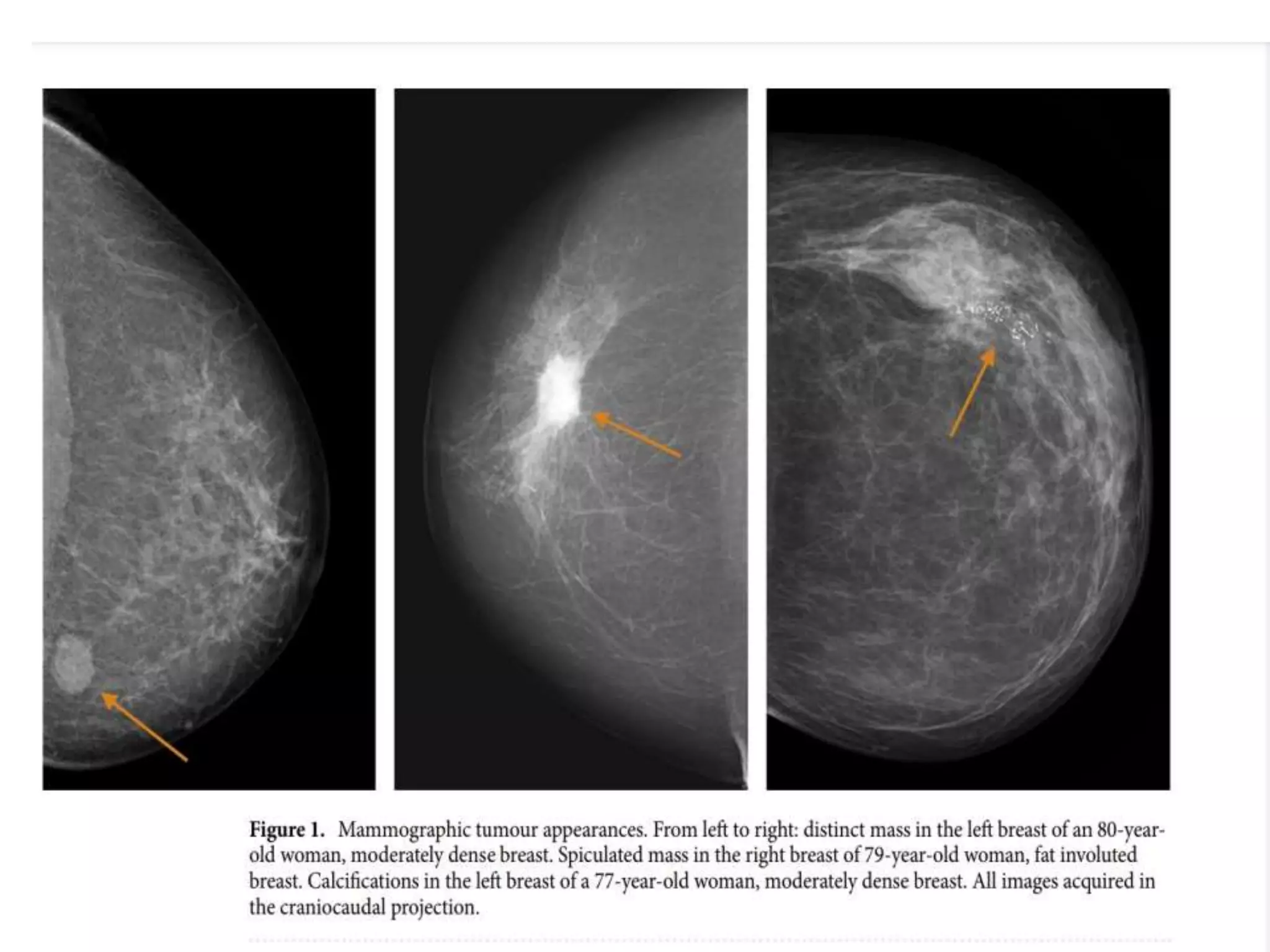 breast imaging and biobsy third .pptx