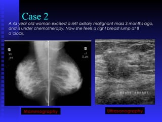 Breast imaging cases | PPT