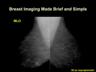 Breast Imaging Made Brief and Simple.ppt